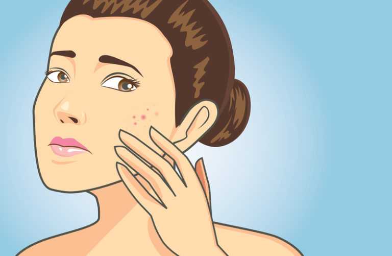Surprising Causes of Acne Breakouts! Hint: It’s not hormones or diet ...