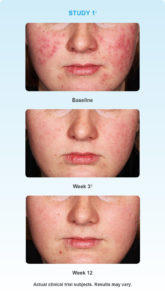 Seysara: Does it work? Side Effects, Dosage & How to Use