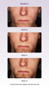 Seysara: Does it work? Side Effects, Dosage & How to Use