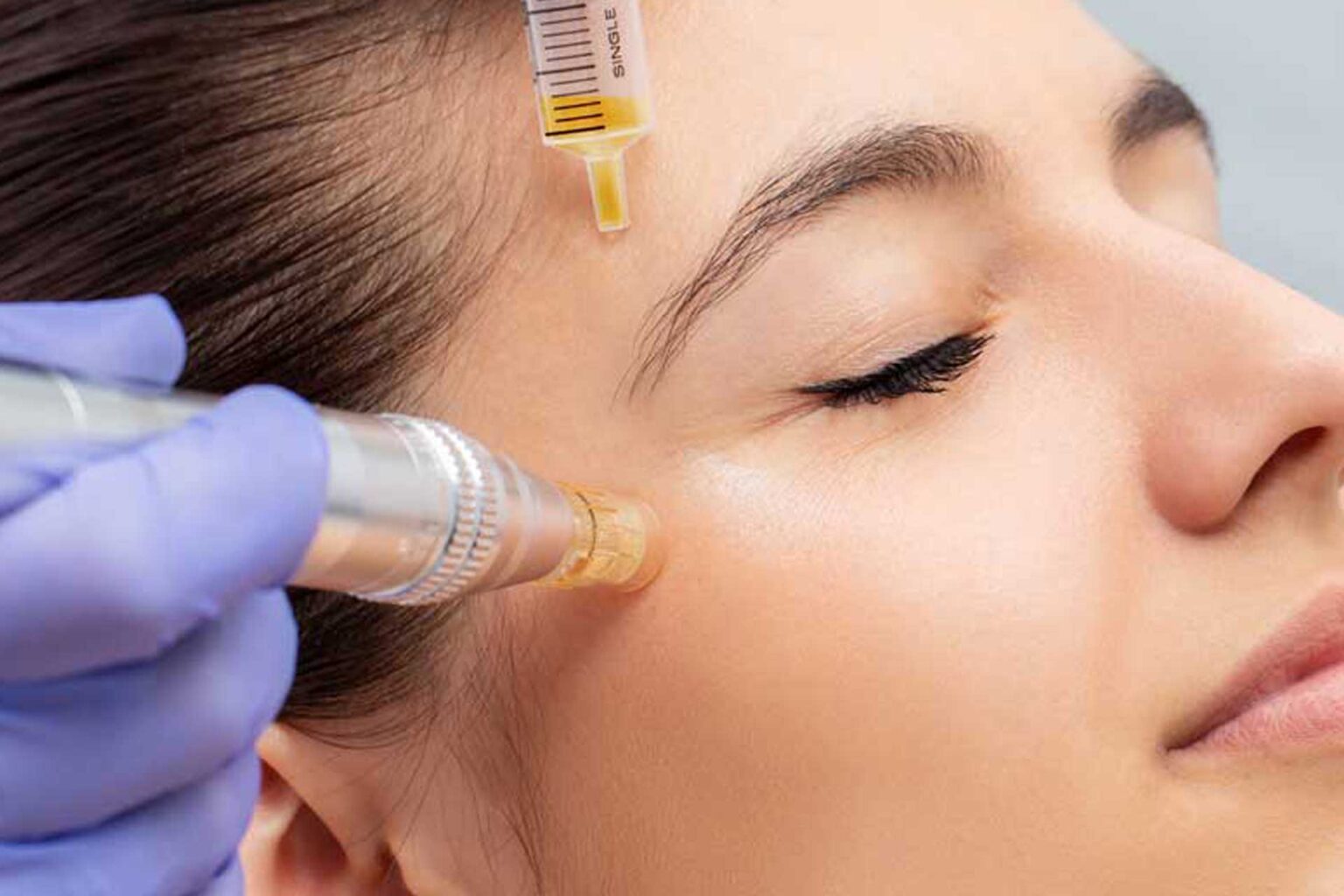 Microneedling with PRP or Exosomes: Which Is More Effective? - Dr ...
